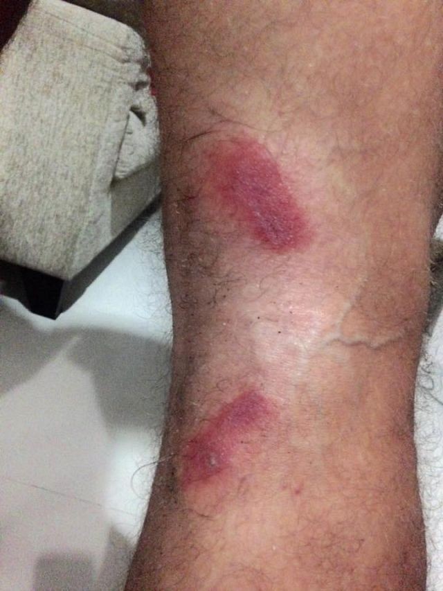 What Is a Tomcat? Bali’s Dangerous Insect Explained - Bali.live